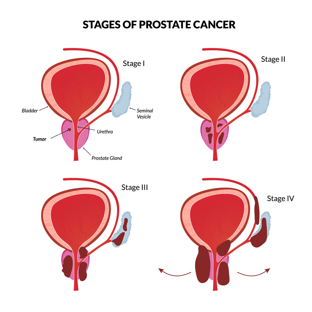 Prostate Cancer Medicentres